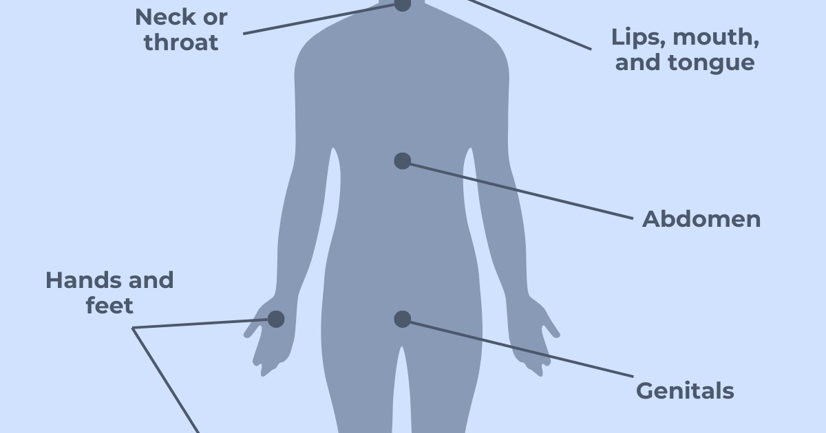 Hereditary angioedema: Causes, symptoms, and treatment | Angioedema News