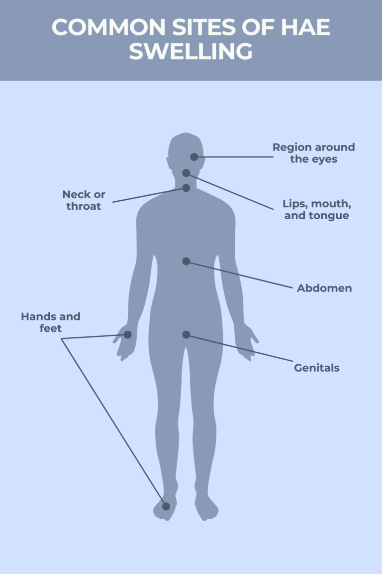 Hereditary angioedema: Causes, symptoms, and treatment | Angioedema News